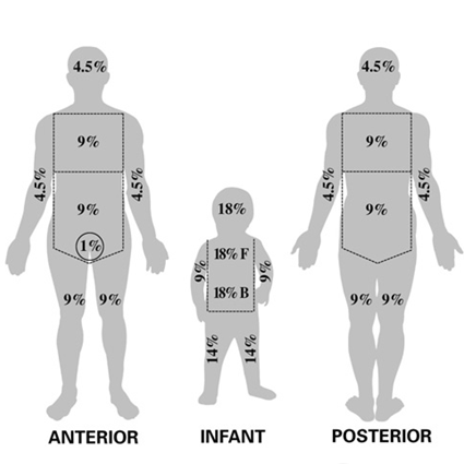 Parkland Formula (Baxter Formula) Calculator for Burns